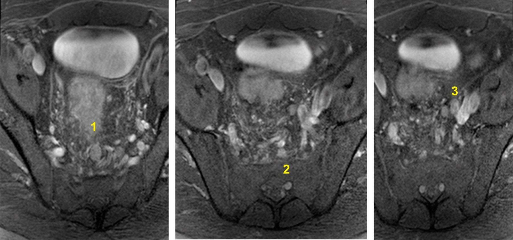 Utilidad de la resonancia magnética en la estadificación del cáncer de ...