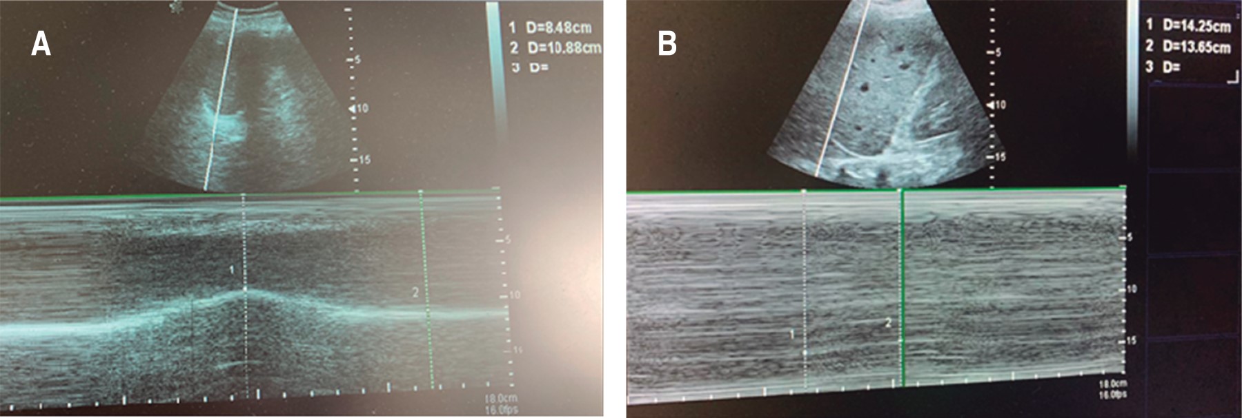 Diaphragmatic dysfunction in critically ill patients with cervical ...