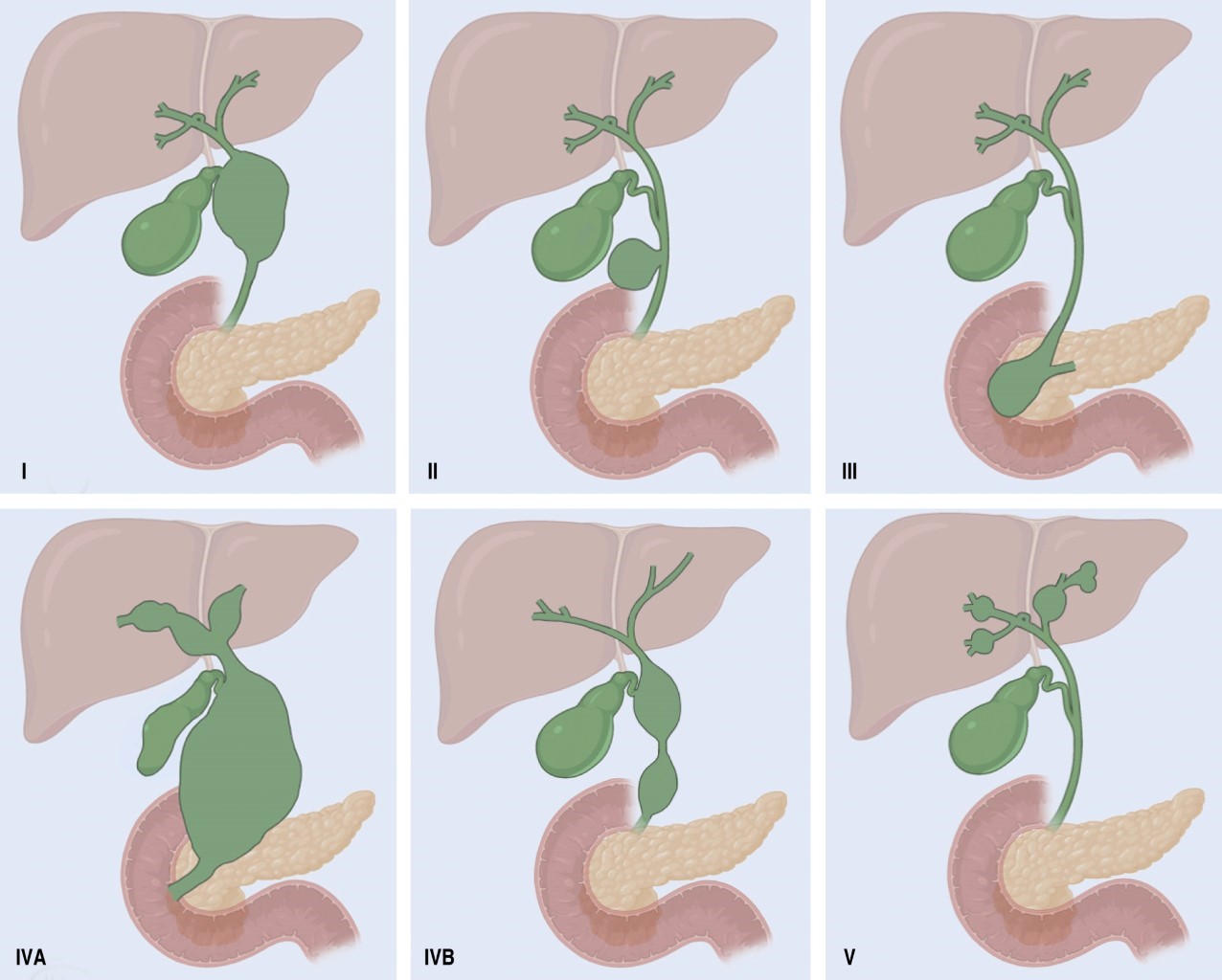 Choledochal cyst type IVA based on Todanis classification