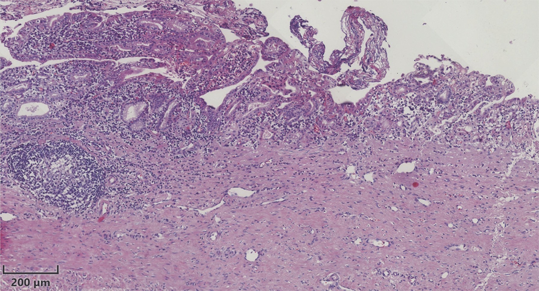 Choledochal cyst type IVA based on Todanis classification