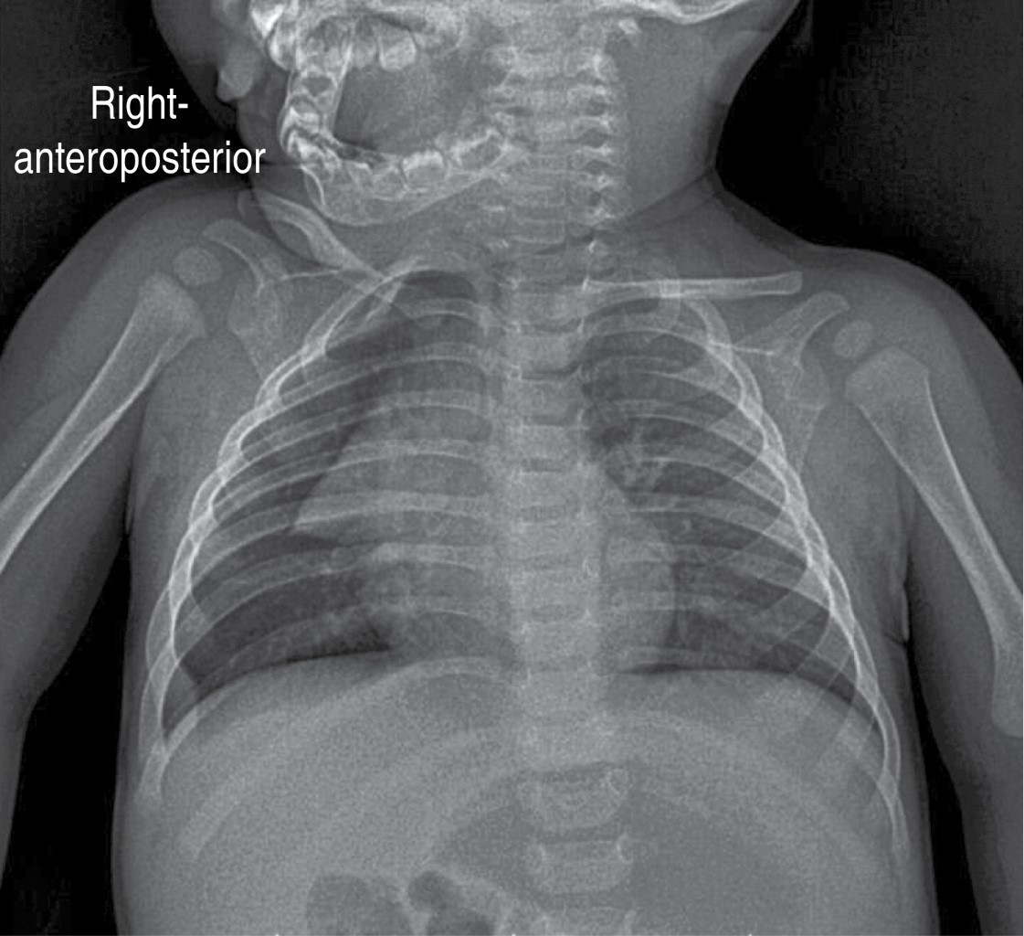 Chest X Ray Pediatric Normal At Darrel Parr Blog Chest X Ray Pediatric Normal At Darrel Parr Blog