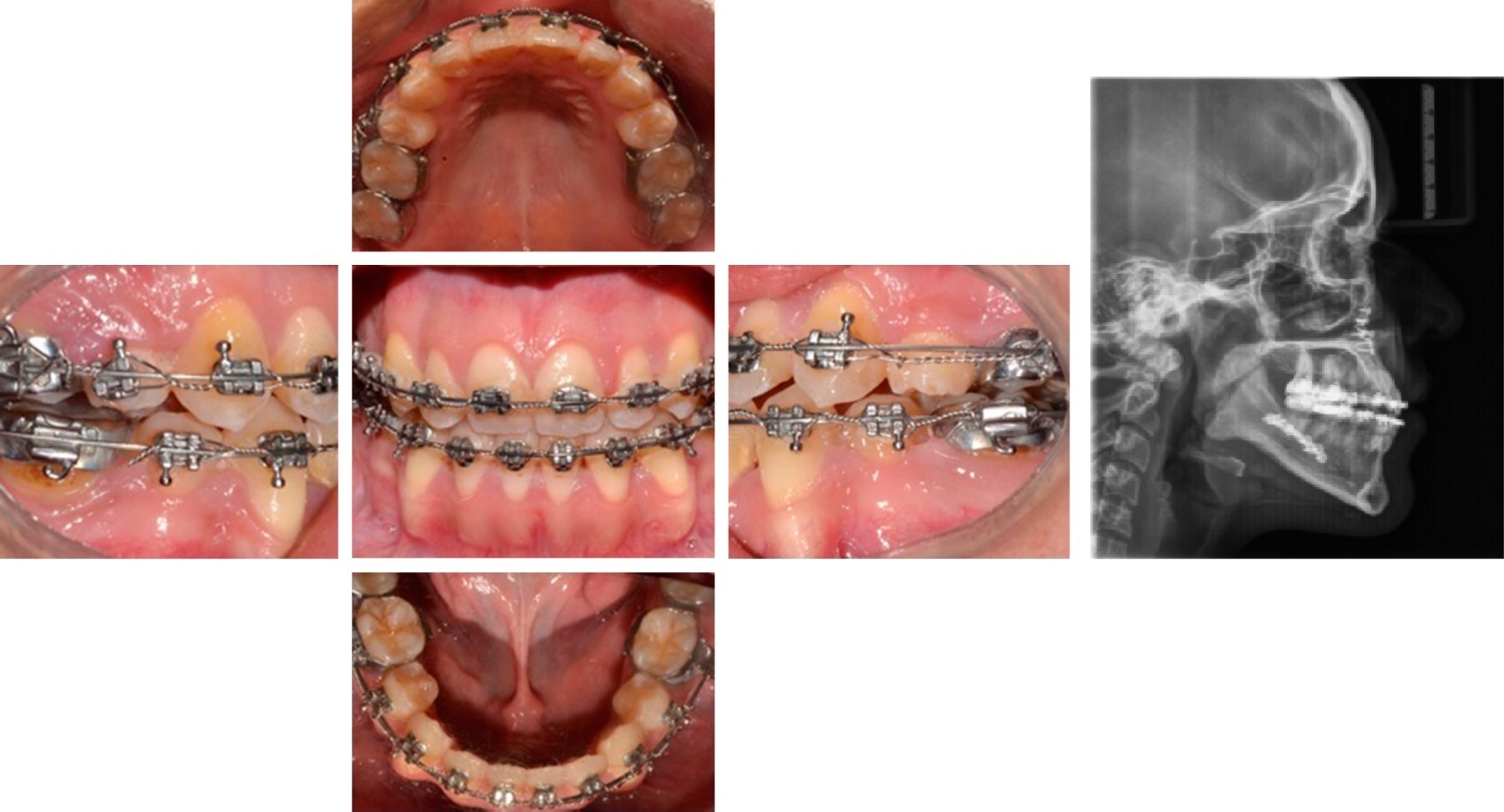 Tratamiento ortodóntico-quirúrgico de maloclusión clase III con apiñamiento severo: reporte de ...