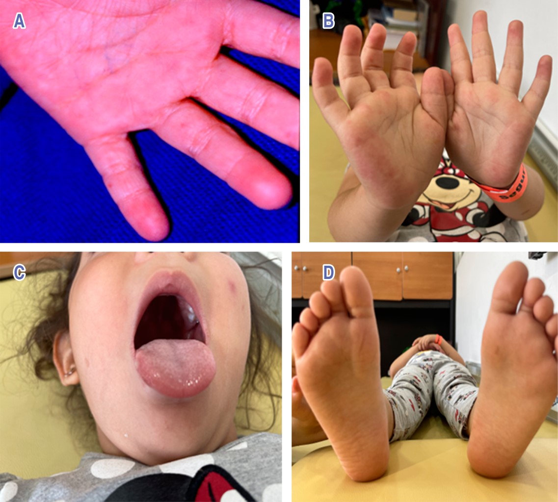 Enfermedad de manos, pies y boca