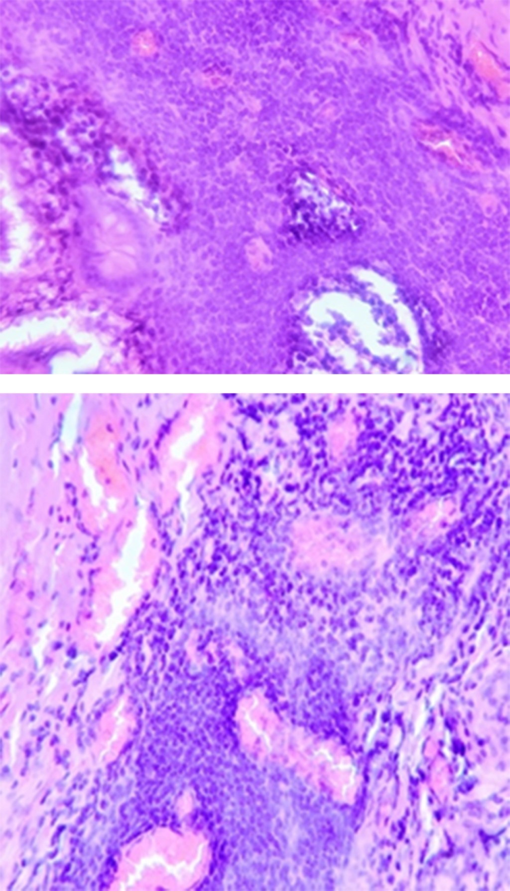 Colonic Perforation Due To Vasculitis In A Patient With SARS CoV 2 Colonic Perforation Due To Vasculitis In A Patient With SARS CoV 2