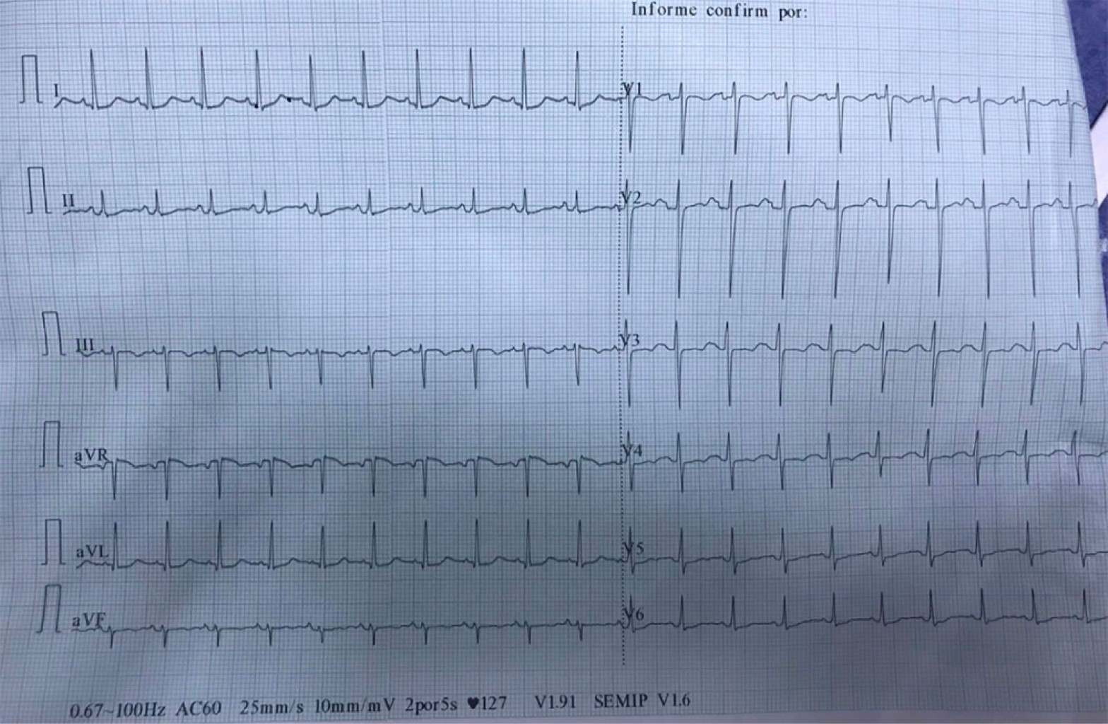 Dengue And The Clinical Manifestation Of Congenital Long Qt Syndrome A Case Report