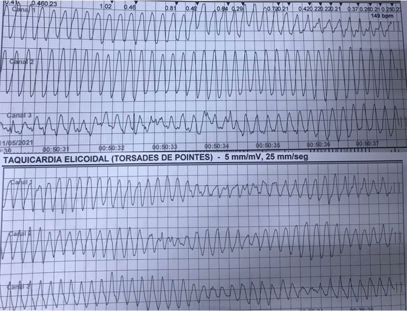 Dengue And The Clinical Manifestation Of Congenital Long Qt Syndrome A Case Report
